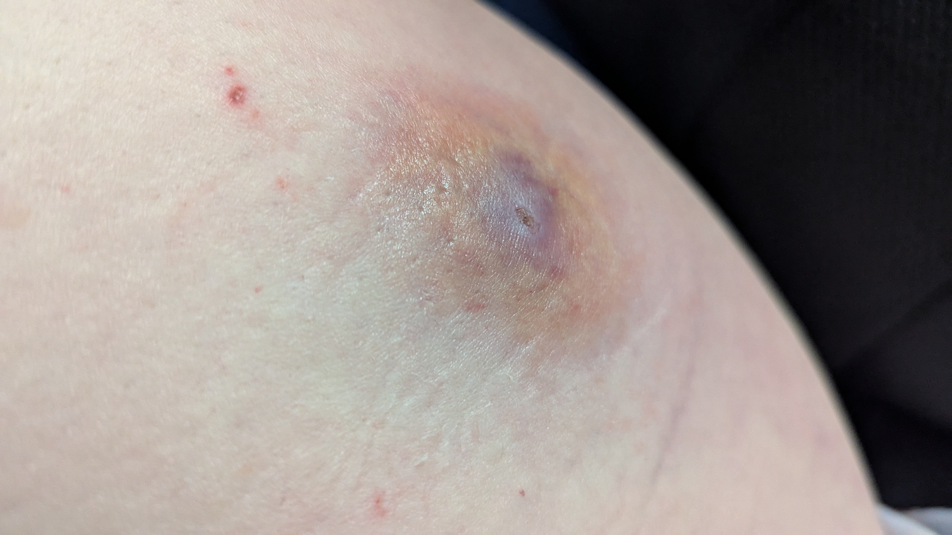 Fundraiser by Doris Holbrook : Support for Recovery After Spider Bite