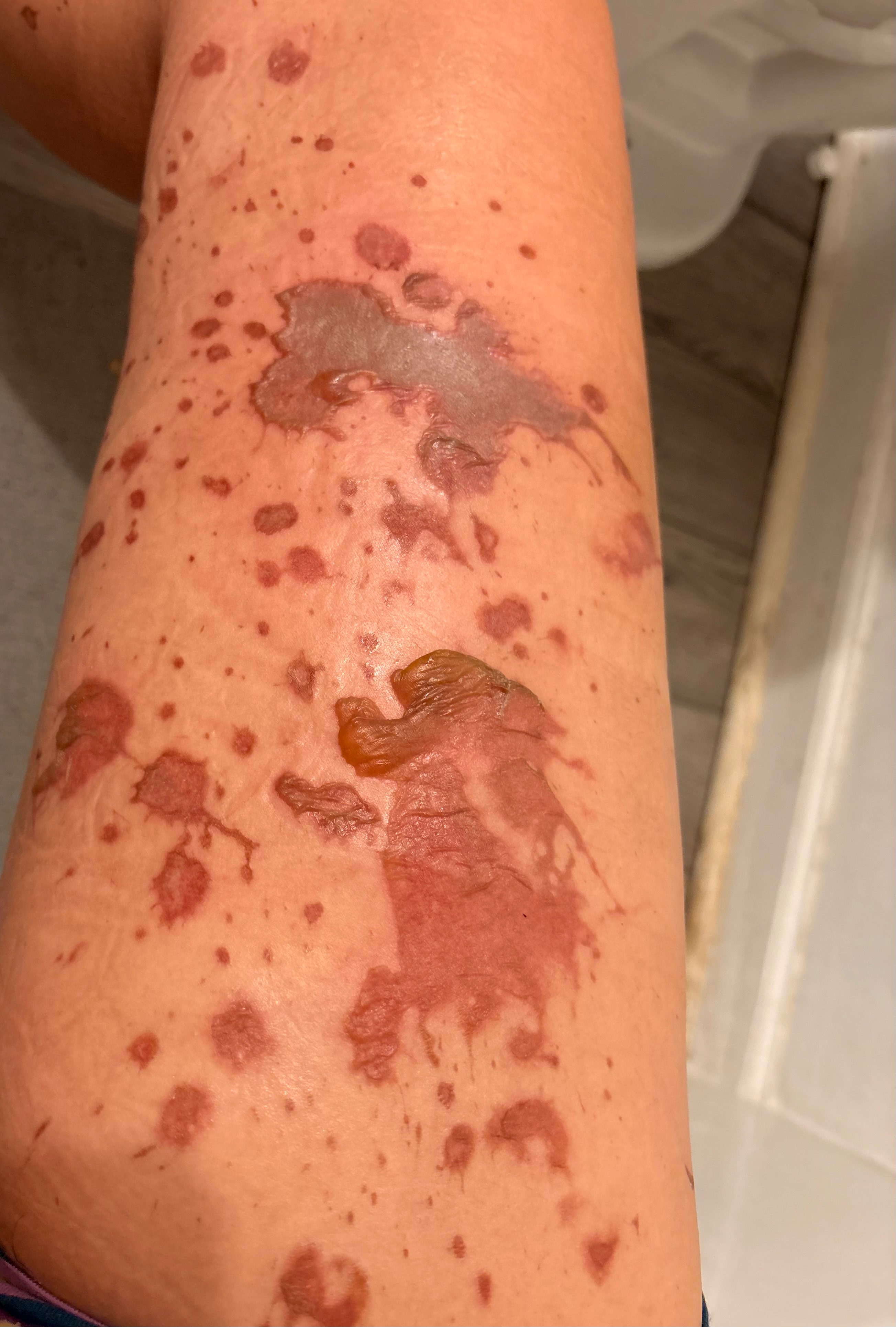 Fundraiser by Beth Straitiff : Care for Yasmin’s Recovery from Burn ...