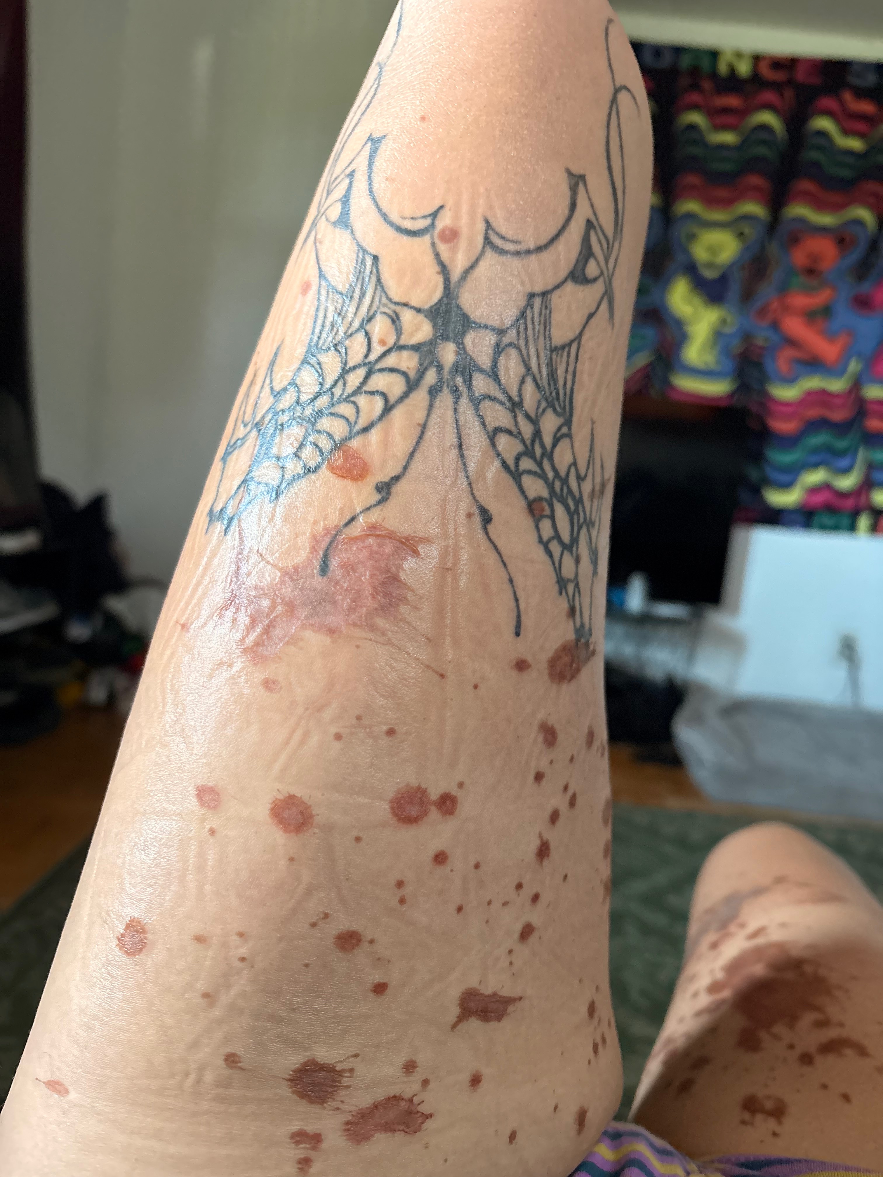 Fundraiser by Beth Straitiff : Care for Yasmin’s Recovery from Burn ...