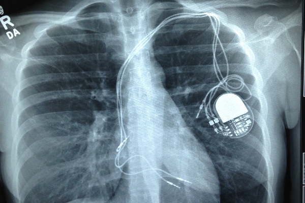 Fundraiser by Camila Espinoza : Pacemaker replacement Surgery