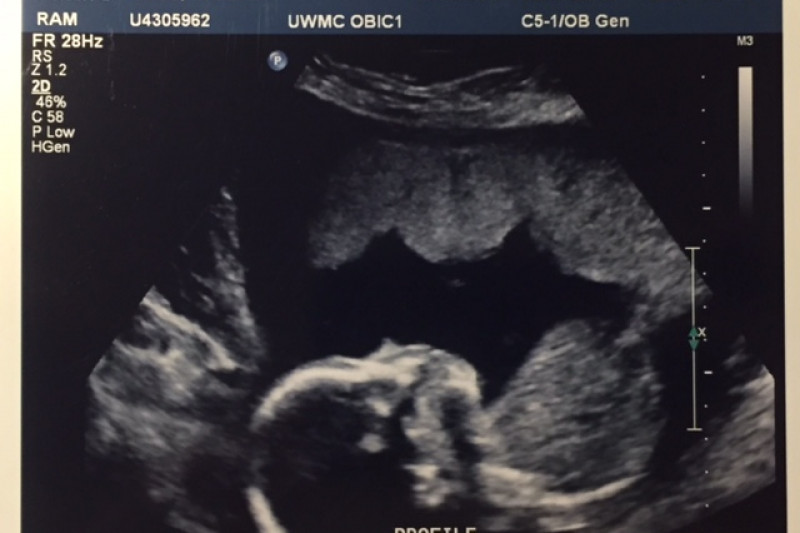 Fundraiser for Hannah Goss by allison bakke : Baby Goss' Medical Expenses