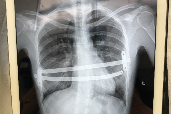 Fundraiser by Sydney Campbell : titanium rib torture