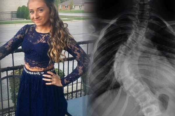 Fundraiser by Chris Redburn : Cailee Redburn's Scoliosis Surgery