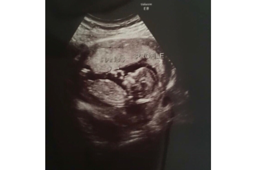 Fundraiser for Rowan Steiner by Alex Dierks : Chloe Steiners Funeral Costs