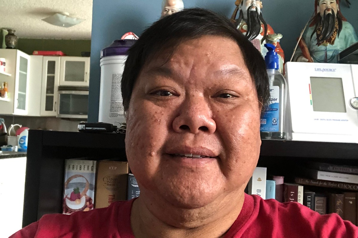 Fundraiser by Alexander Seto : Kidney Transplant Medical Expenses