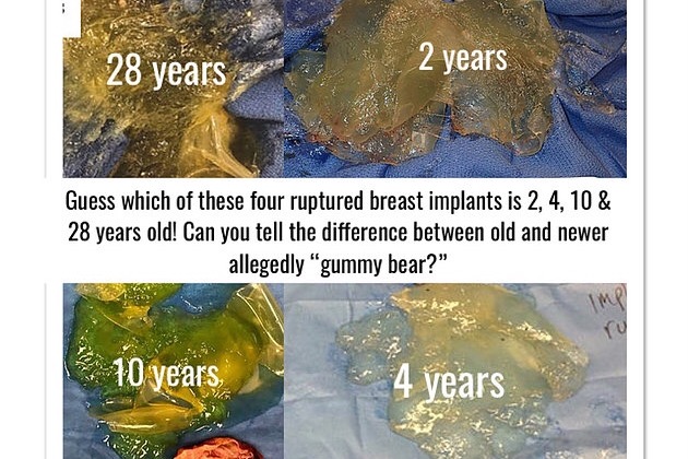 Fundraiser by Talea Faircloth : VERY ILL FROM IMPLANTS!!! Must have Removed