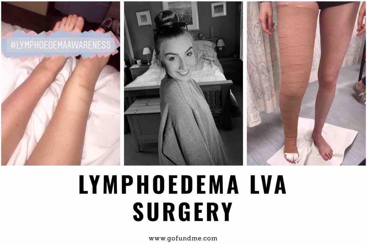 Fundraiser by Rachael Boggiano : Lymphoedema LVA Surgery