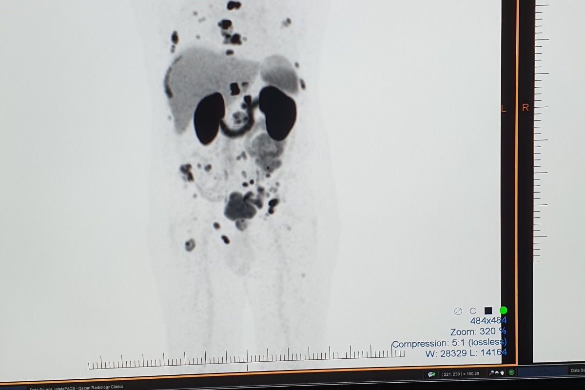 Fundraiser by Shaun McIntyre : Shaun McIntyre Lutetium 177 Cancer Treatment