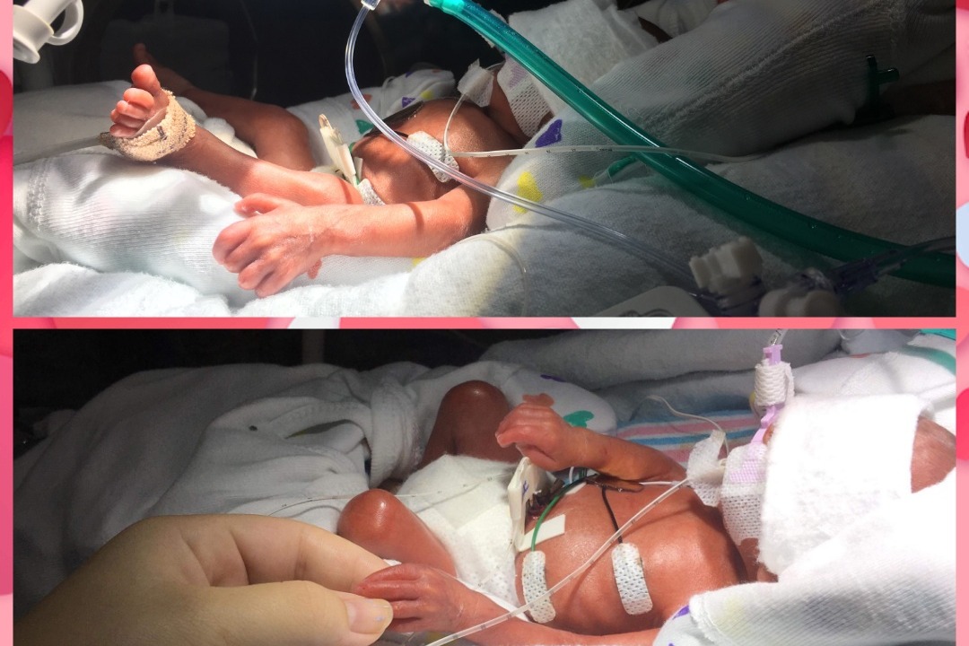 Fundraiser for Madison foster by Tisha Conner : 25 wk. twin sisters