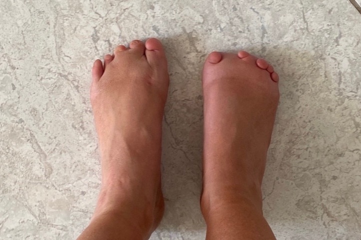 Fundraiser by Rachael Justins : Help me raise money to buy prosthetic toes