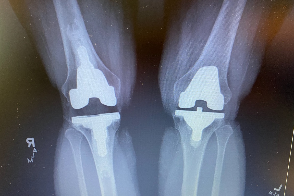 Fundraiser by Martha Garris : Knee Replacement Surgery for Martha