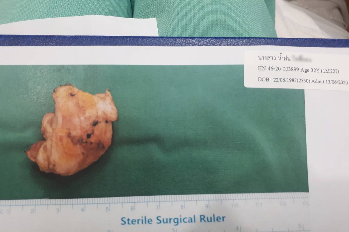 Fundraiser by Robert Le Page : Breast Cancer Removal GoFundMe