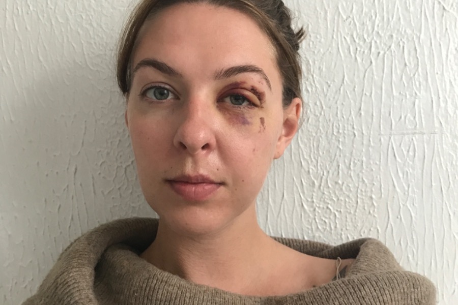 Fundraiser by Talia Clark : Bicycle Crash Medical Cost