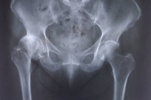 Fundraiser by Daniela Romero : Help Tia Alba with her hip surgery