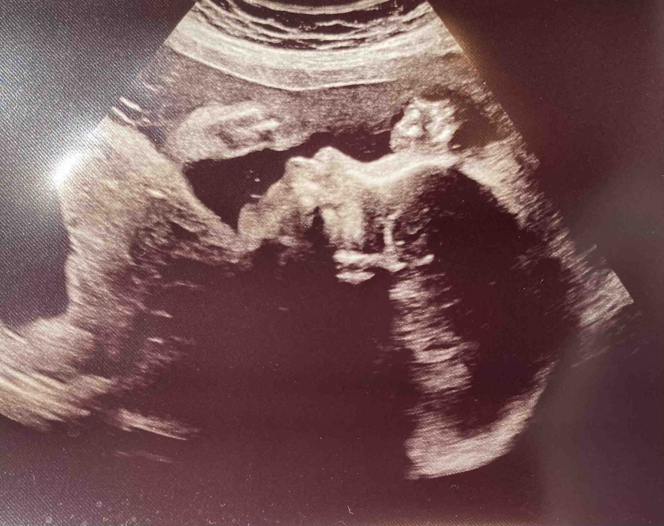 Fundraiser for Aaron Ratliff by Amy Bumpus : Help Baby Ratliff to ...