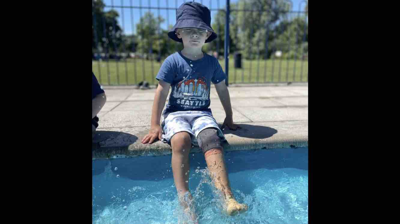 Fundraiser by E Jameson : Help fund a new leg for Elijah