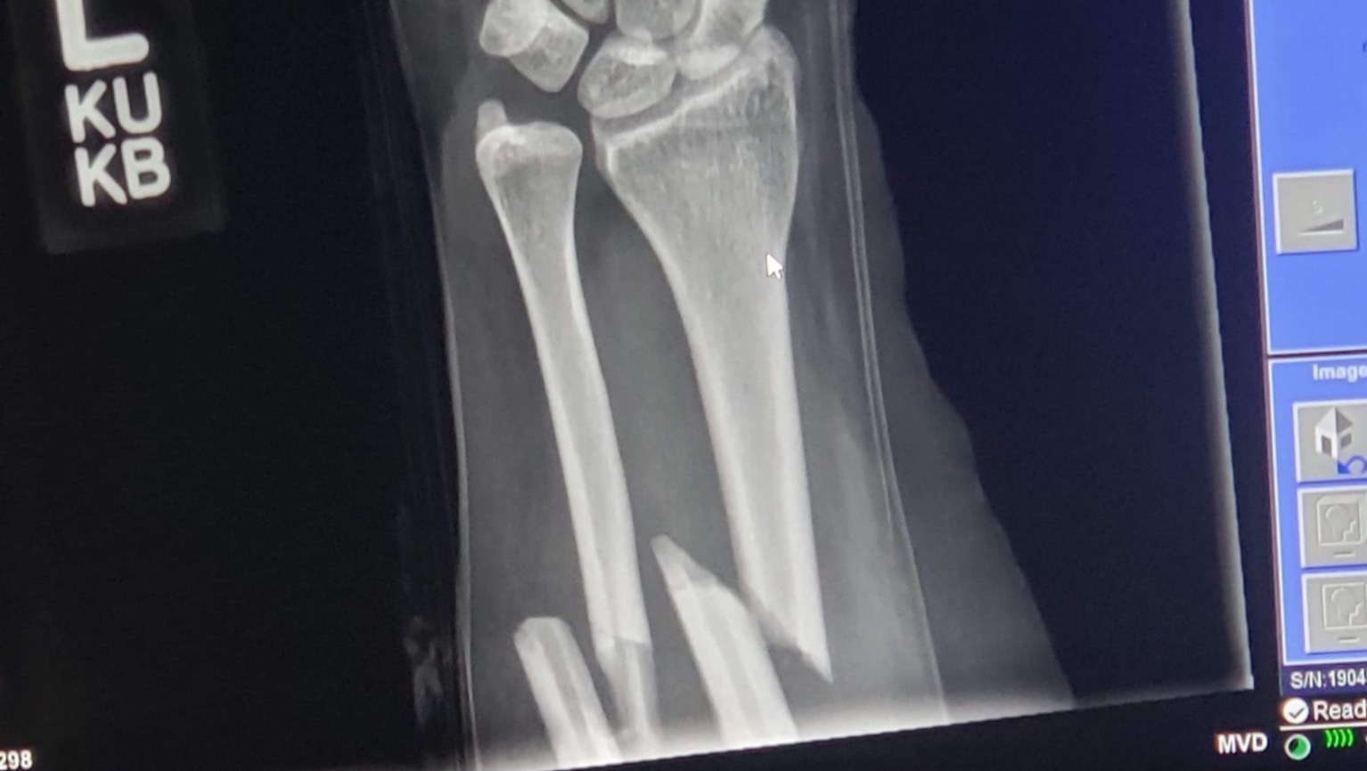 Fundraiser for Amanda Kuiken by Jennifer Jaffres : Amanda's Surgery ...