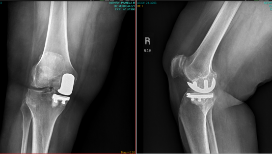 Fundraiser for Brian Fernander by Kenneth Newry : Pamela Newry Full ...