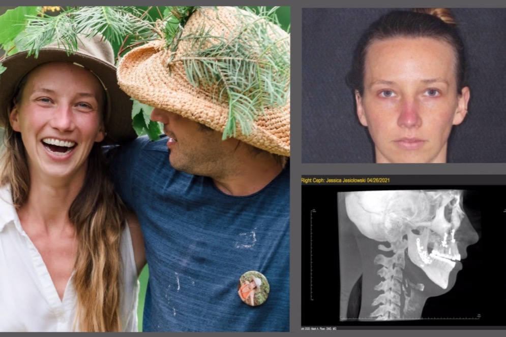 Fundraiser by Jessica Jesiolowski : Life-Changing Corrective Jaw ...