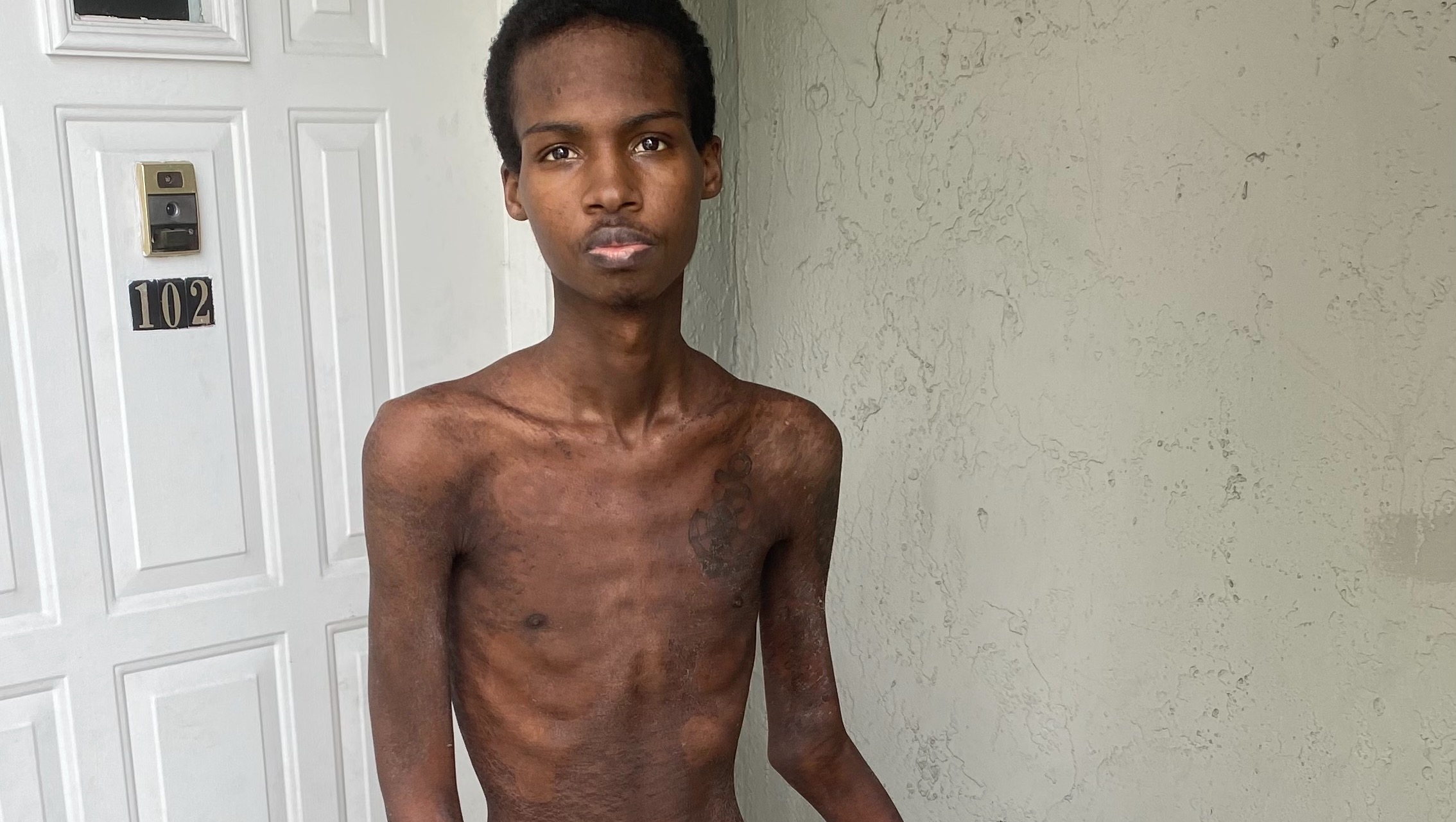 Fundraiser by Desno Dean : Help Desno Get Physical Therapy