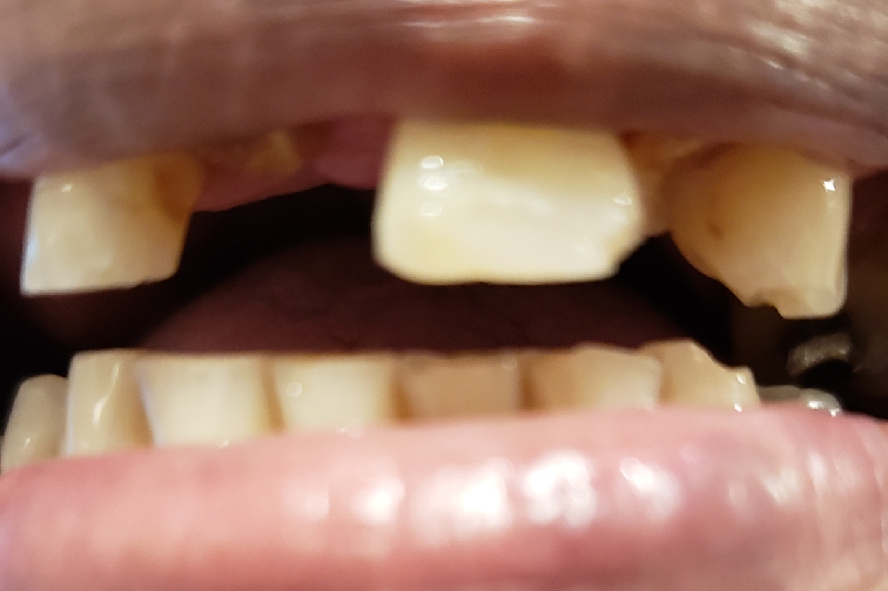 Fundraiser by Iris Perdomo : Help Iris Perdomo fix her teeth