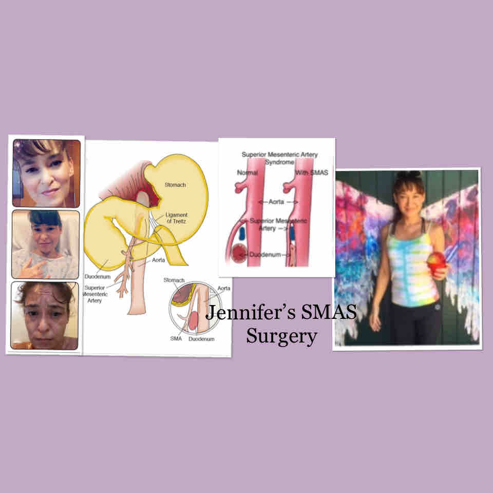 Fundraiser by Jennifer Roddy : Help Jennifer get SMAS surgery in Germany