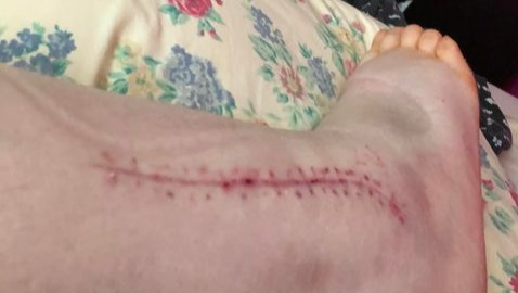 Fundraiser by Victoria Wright : Severe Leg Injury Med Bills