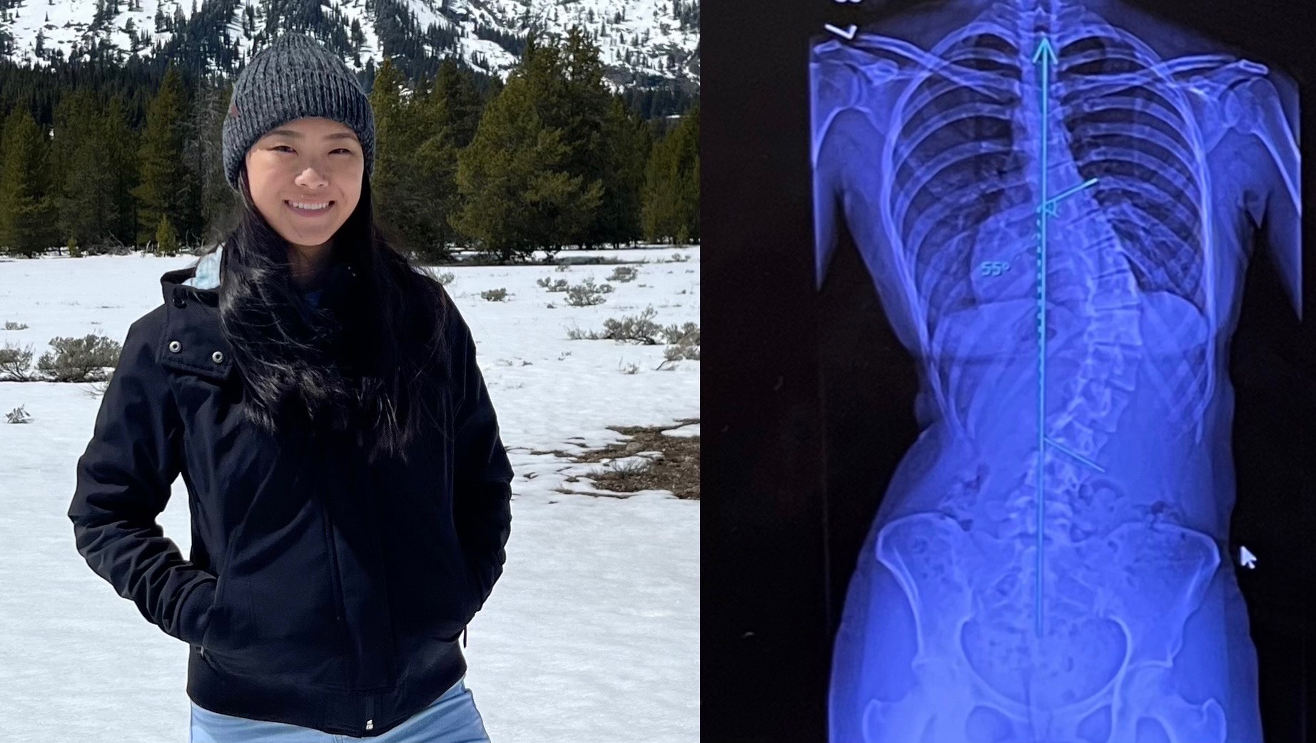 Fundraiser for Sara Riley by Randi Fasnacht : Rose’s Scoliosis Surgery