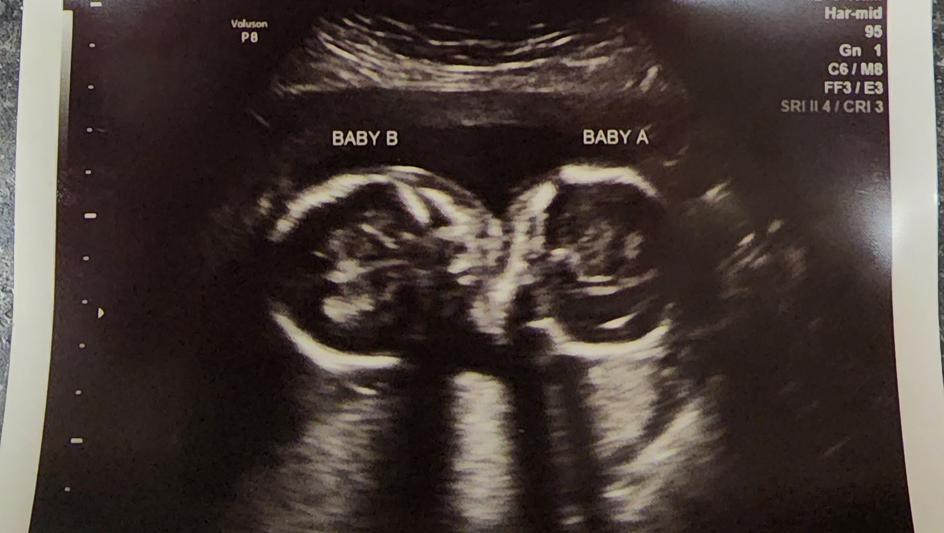 Fundraiser by Mario Sanchez : Conjoined Twins
