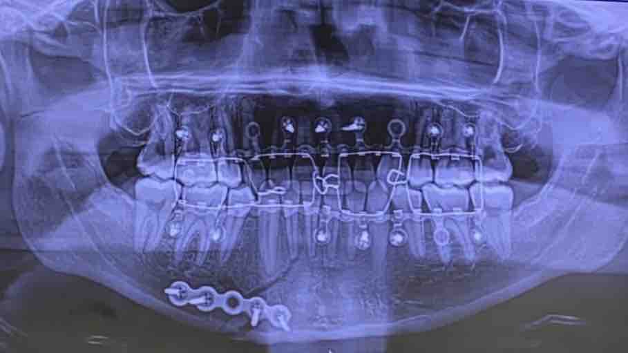 Fundraiser by Abraham Robledo : Broken jaw medical expenses