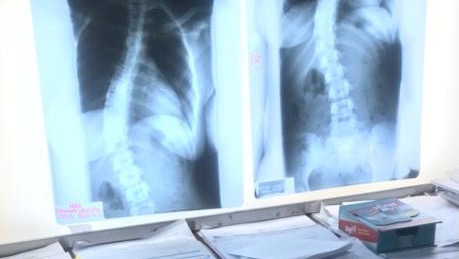 Fundraiser by Malucci Joseph : Help Young Mericka get her Scoliosis Surgery