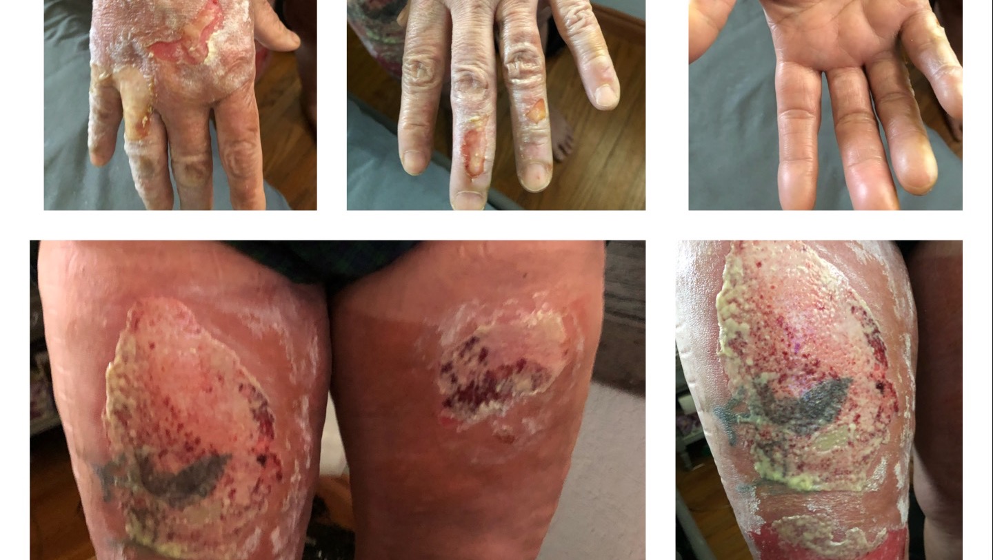 Fundraiser by Autumn Dempsey : Help Stacey on her road to recovery ️‍