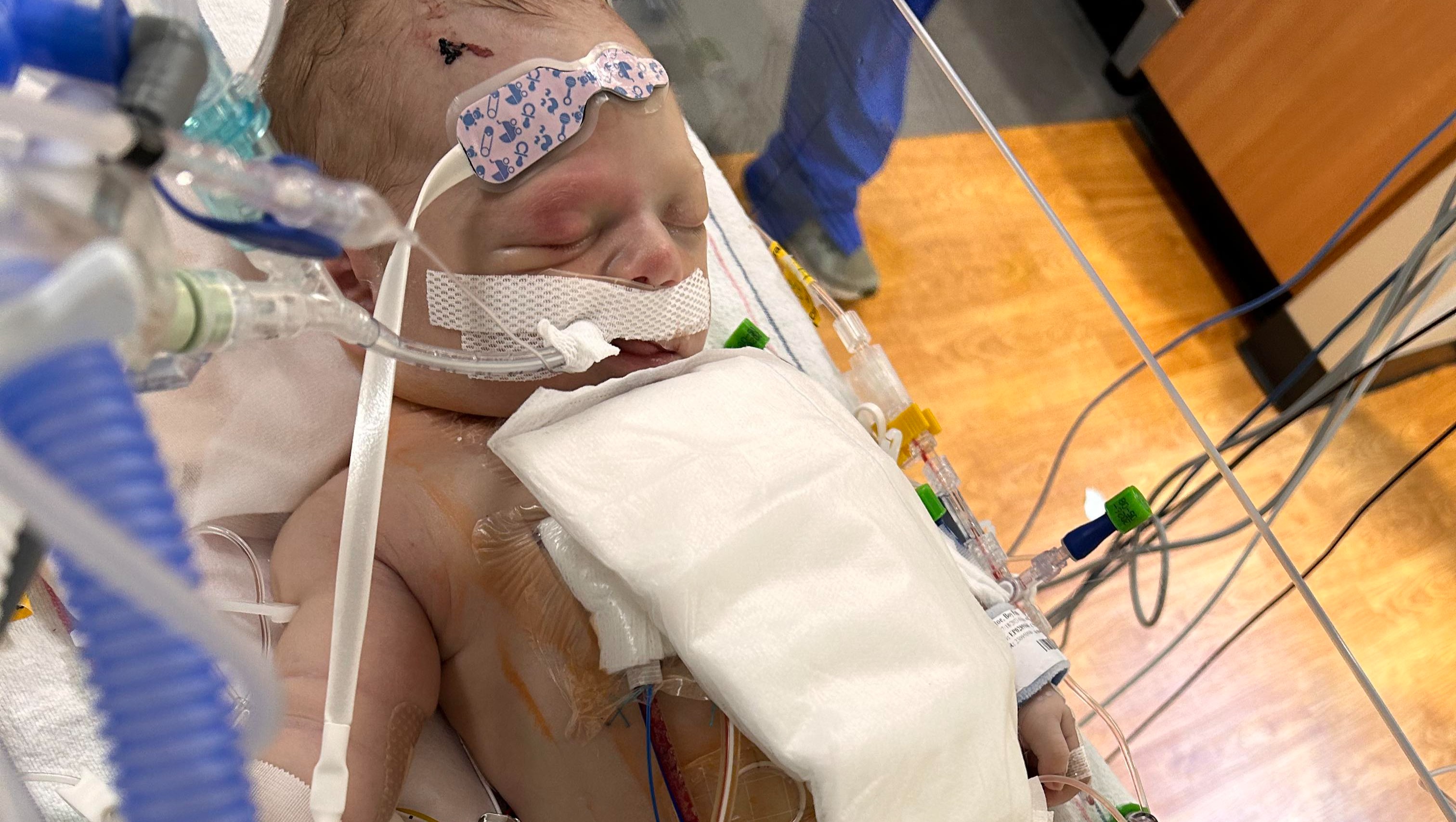 Fundraiser by Joanna Smith : Grayson survive Hypoplasty left heart syndrome