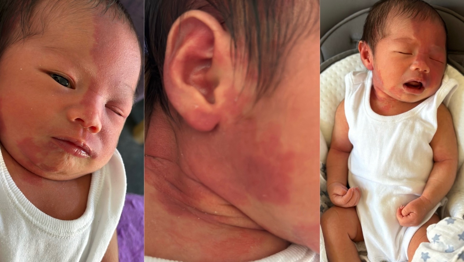 Fundraiser by Randy Bayubay : Support Enzo's fight with Sturge Weber ...