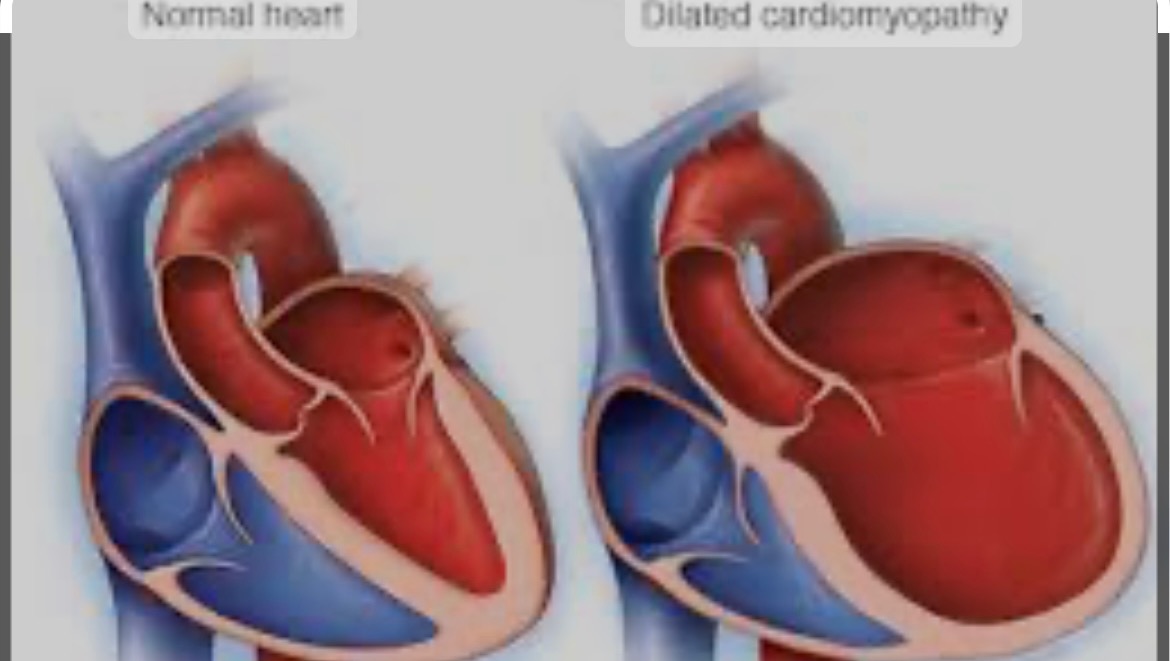 Fundraiser by Julie Naylor : Peripartum Cardiomyopathy: heart failure