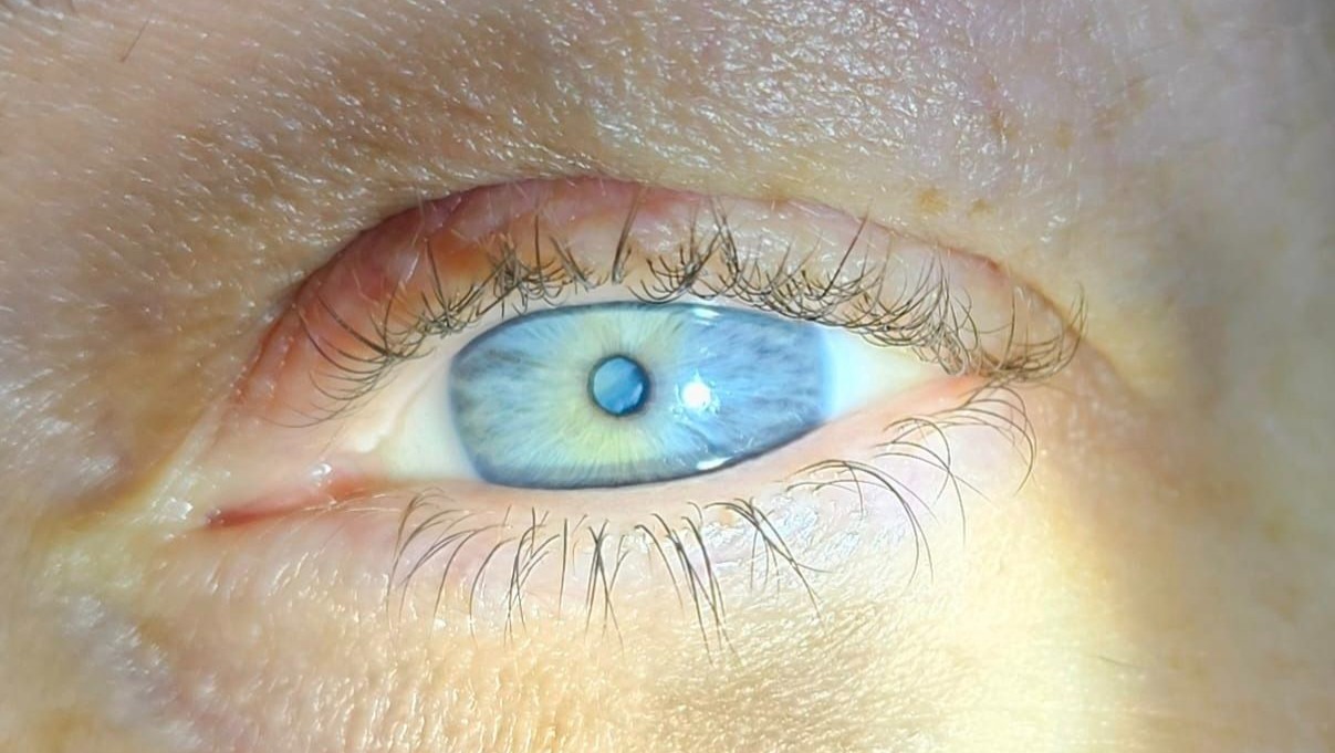 Fundraiser by Susan Johnson : Double Cataract Surgery & Lens ...