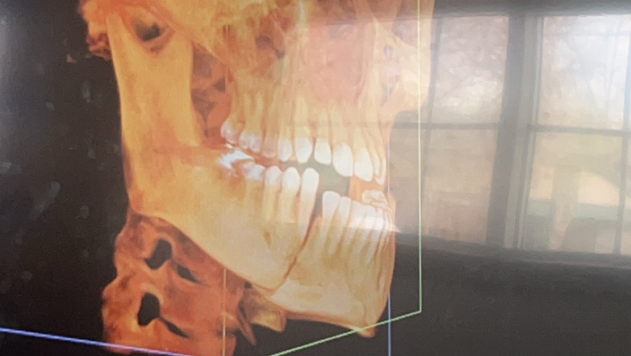 Fundraiser by Patrick White : Broken jaw surgery