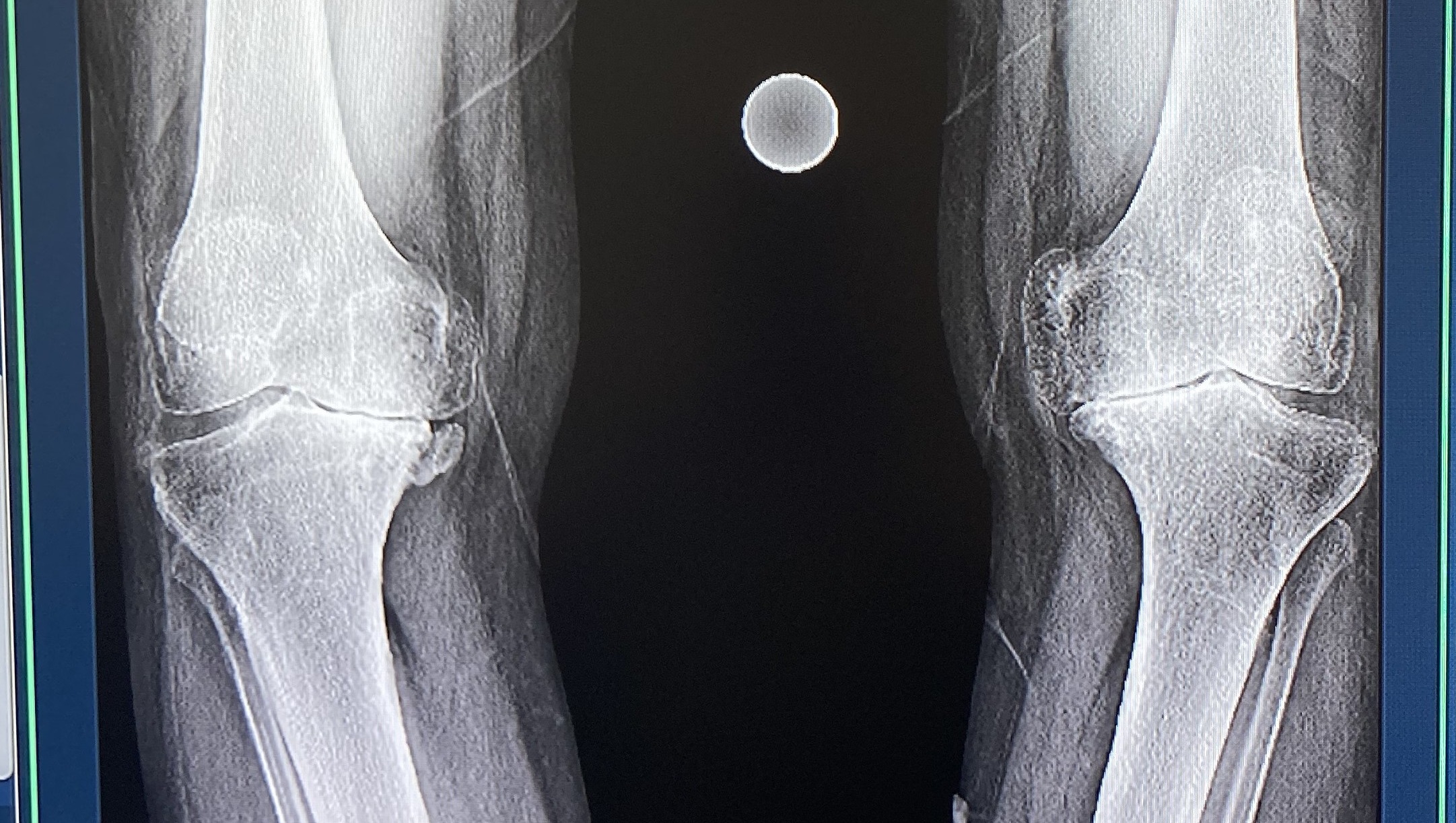 Fundraiser for Skye Daniels by DEREK BERLIN : Help Skye Walk Without ...