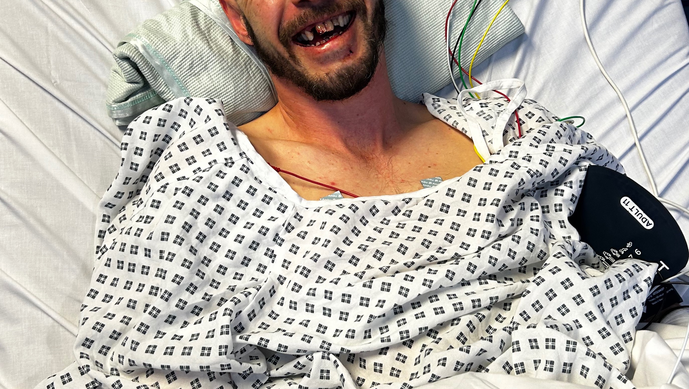 Fundraiser by James Peverill : Help with my friends teeth after he ...