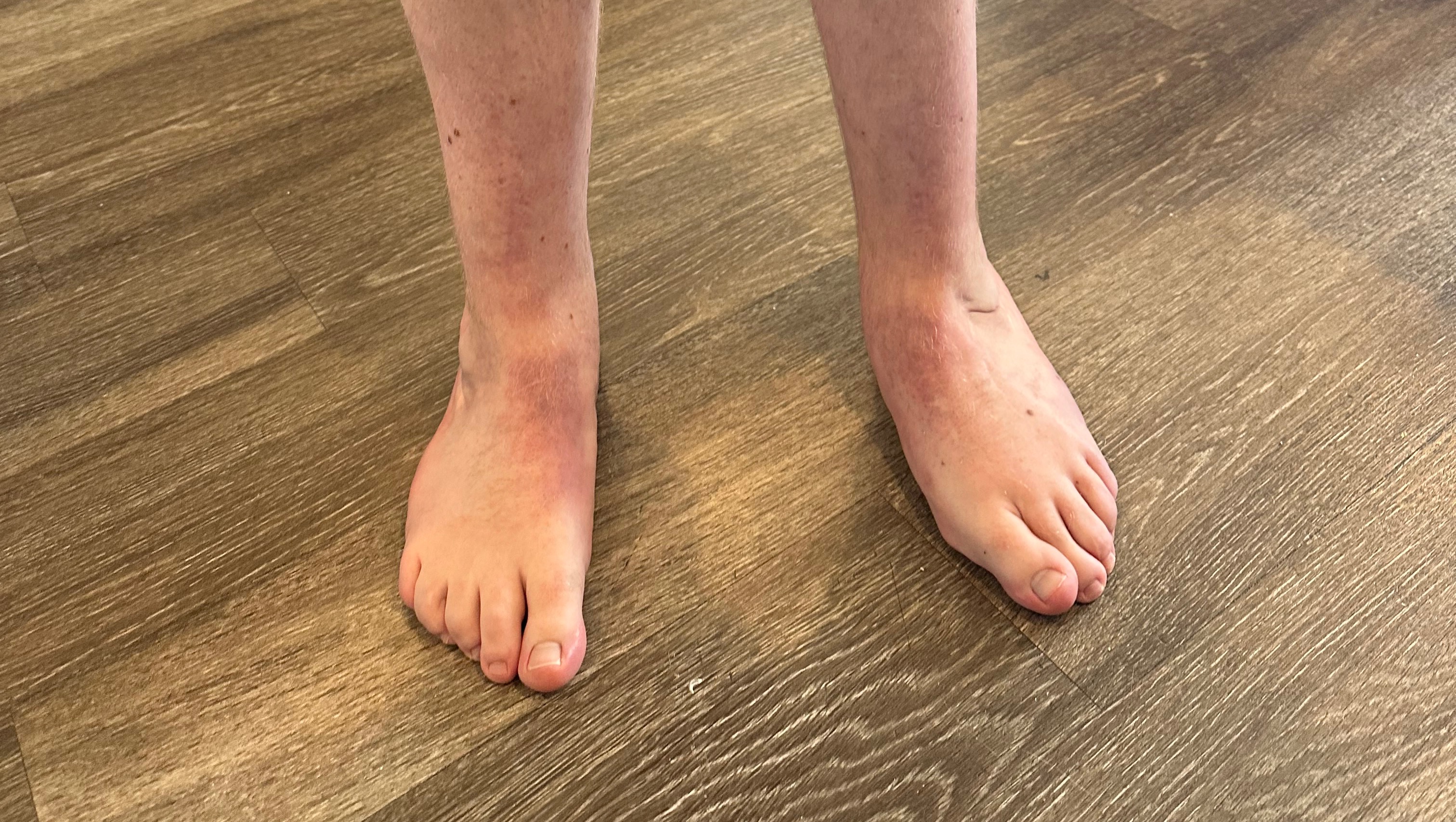 Fundraiser by Nathan Lewis : Help me get ExoSym braces to regain my ...