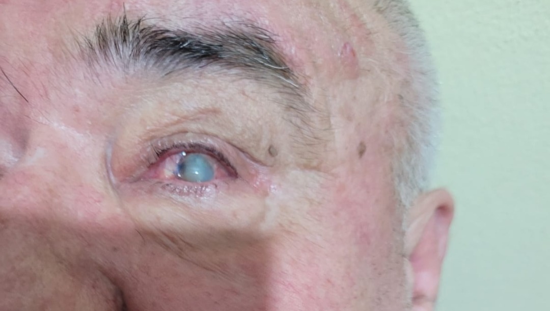 Fundraiser by Xhensila Koci : Support Meti's Eye Surgery and Wife's ...