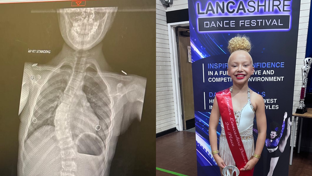 Fundraiser by Helen Jones : Champion dancer Niamh requires scoliosis ...