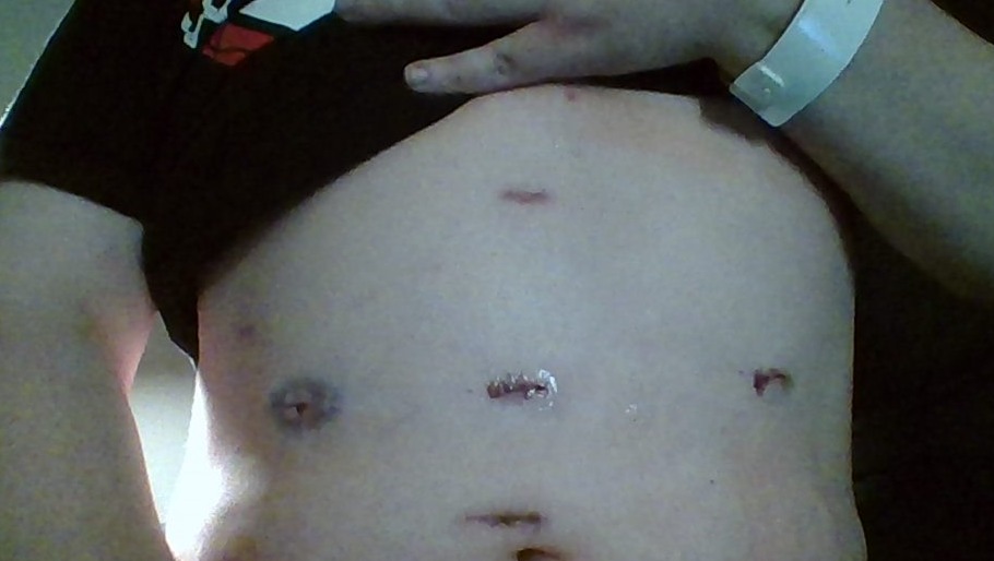 Fundraiser by David Rotella : David's Kidney Cancer Recovery