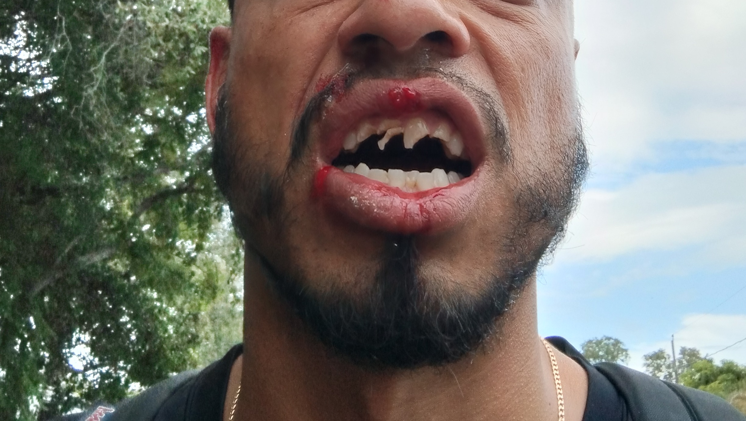 Fundraiser by Cess Colindres : Help Cesar Overcome His E-Bike Accident ...