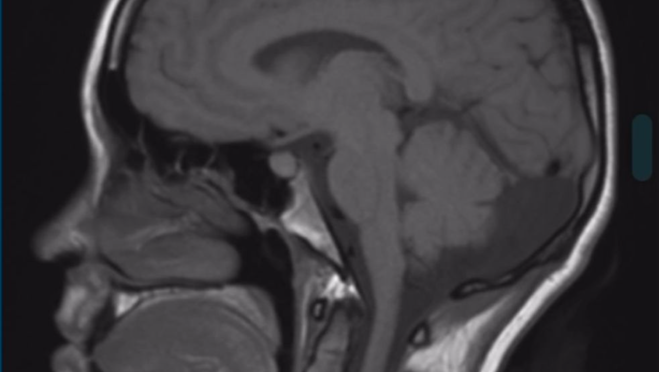 Fundraiser by Itzel amanda Del Villar : Macrodenoma hipofisiario