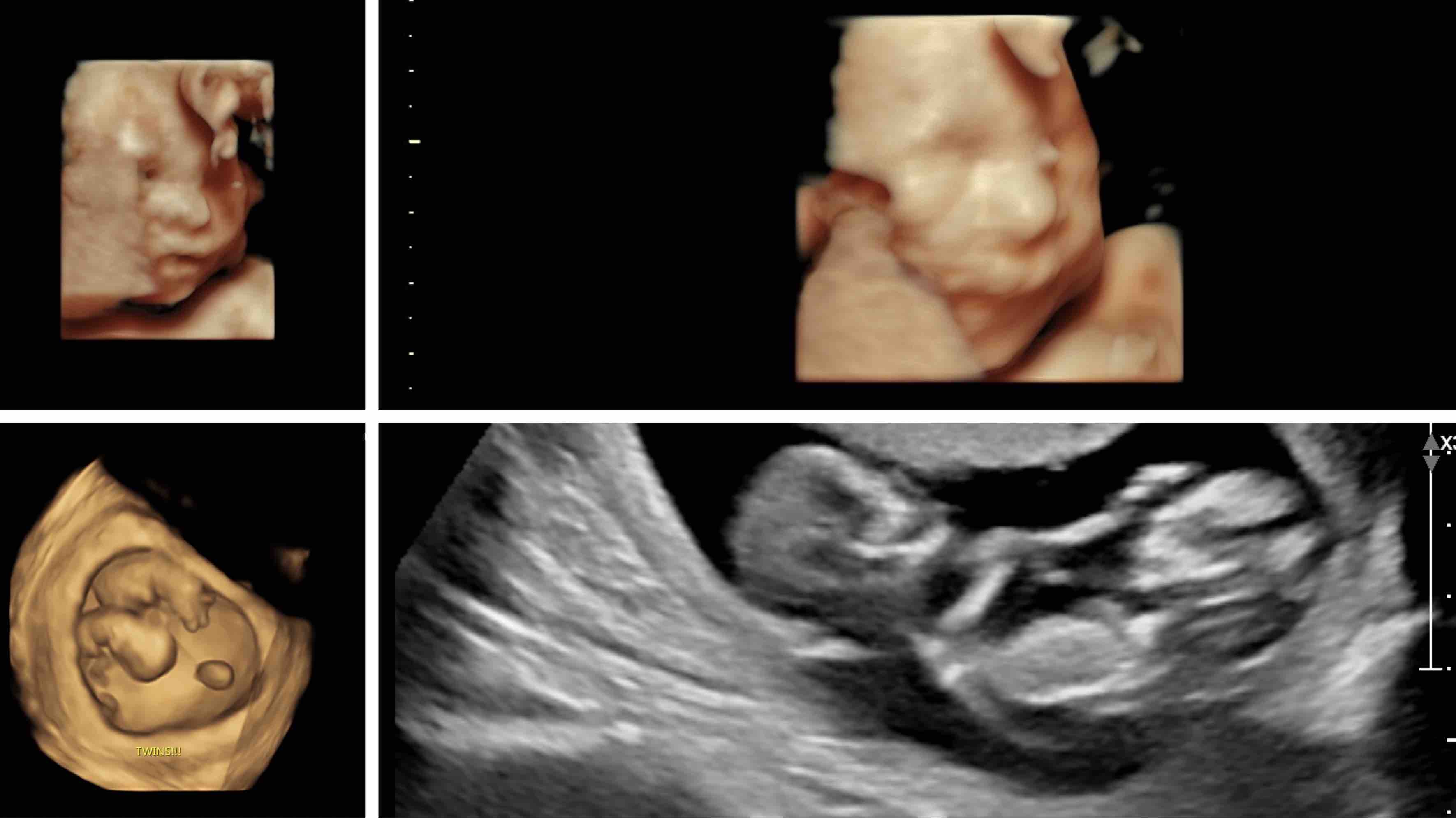 Fundraiser by cameryn conway : Davis Twins TTTS & TAPS Journey