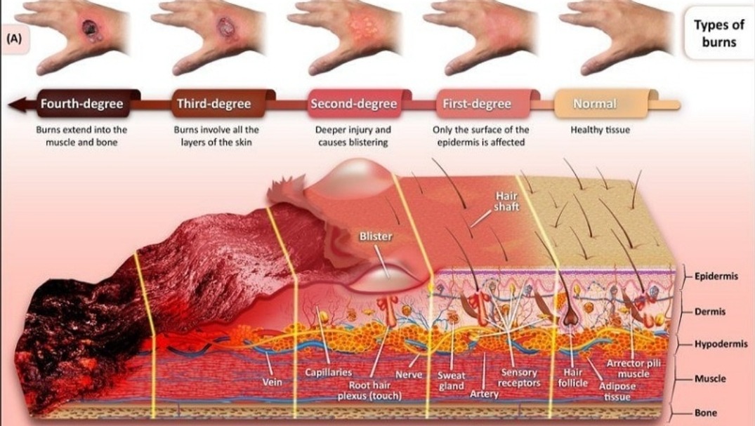Fundraiser by Luann Deanna : Help Maggie Heal from Severe Burn Injuries