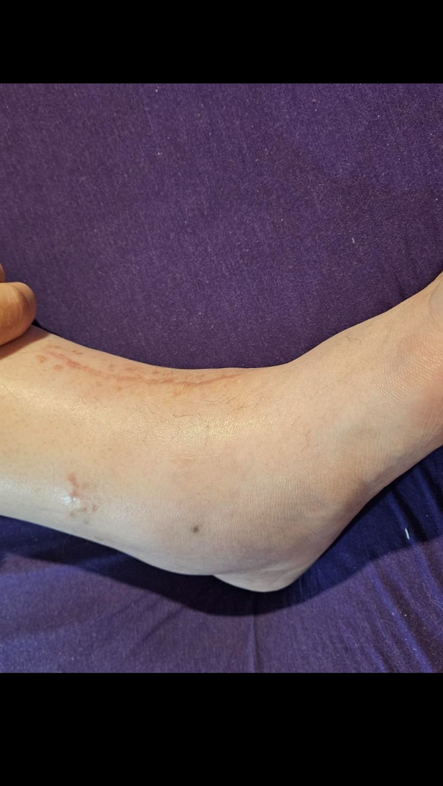 Fundraiser by Amy Green : Corrective Prosthetic Boot for Kenneth Green ...