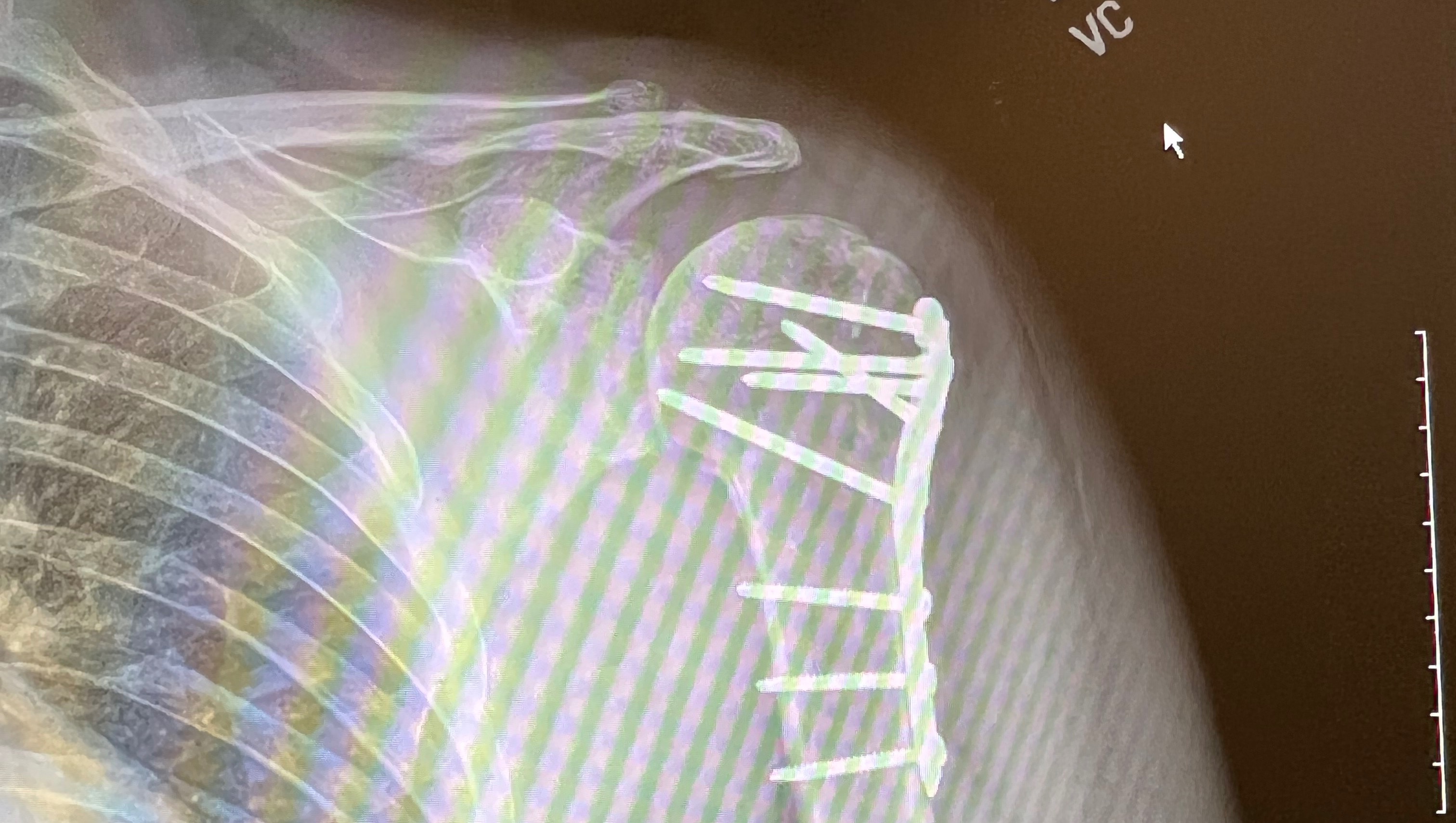 Fundraiser by Zach Hart : Help Zach Fund Stem Cell Research for MS