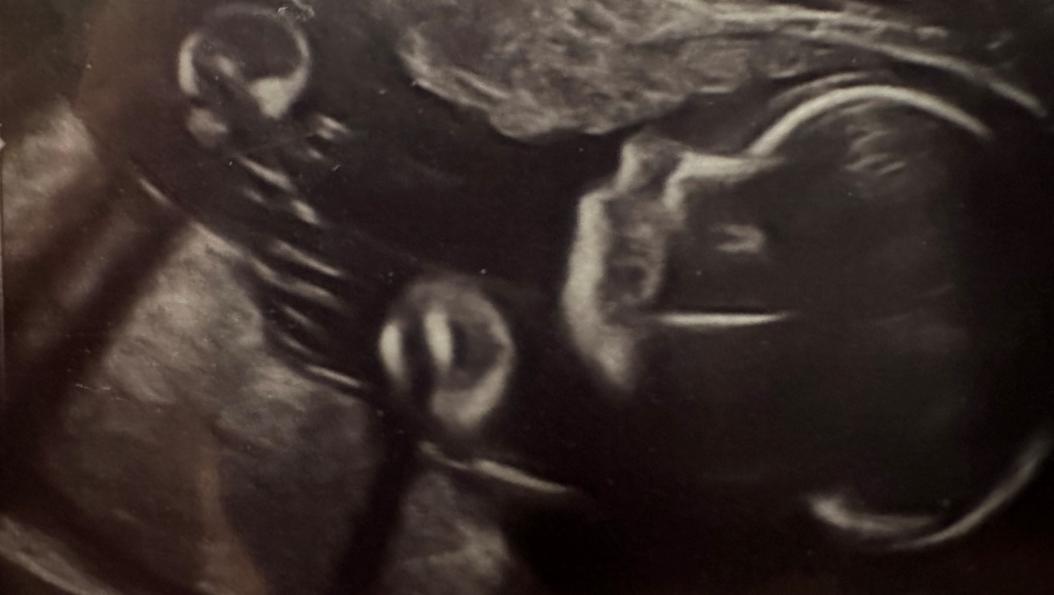 Fundraiser for Emily Duffy by Meghan Cota : Give Baby Tyler a Fighting ...